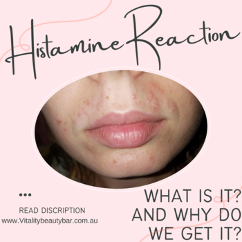 Histamine Reaction: What is it? why do we get it?
